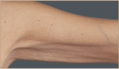 PROFHILO Body - Alma Profhilo