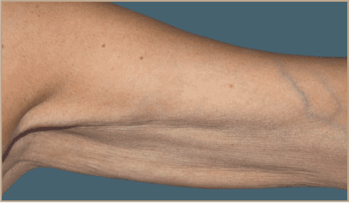 PROFHILO Body - Alma Profhilo